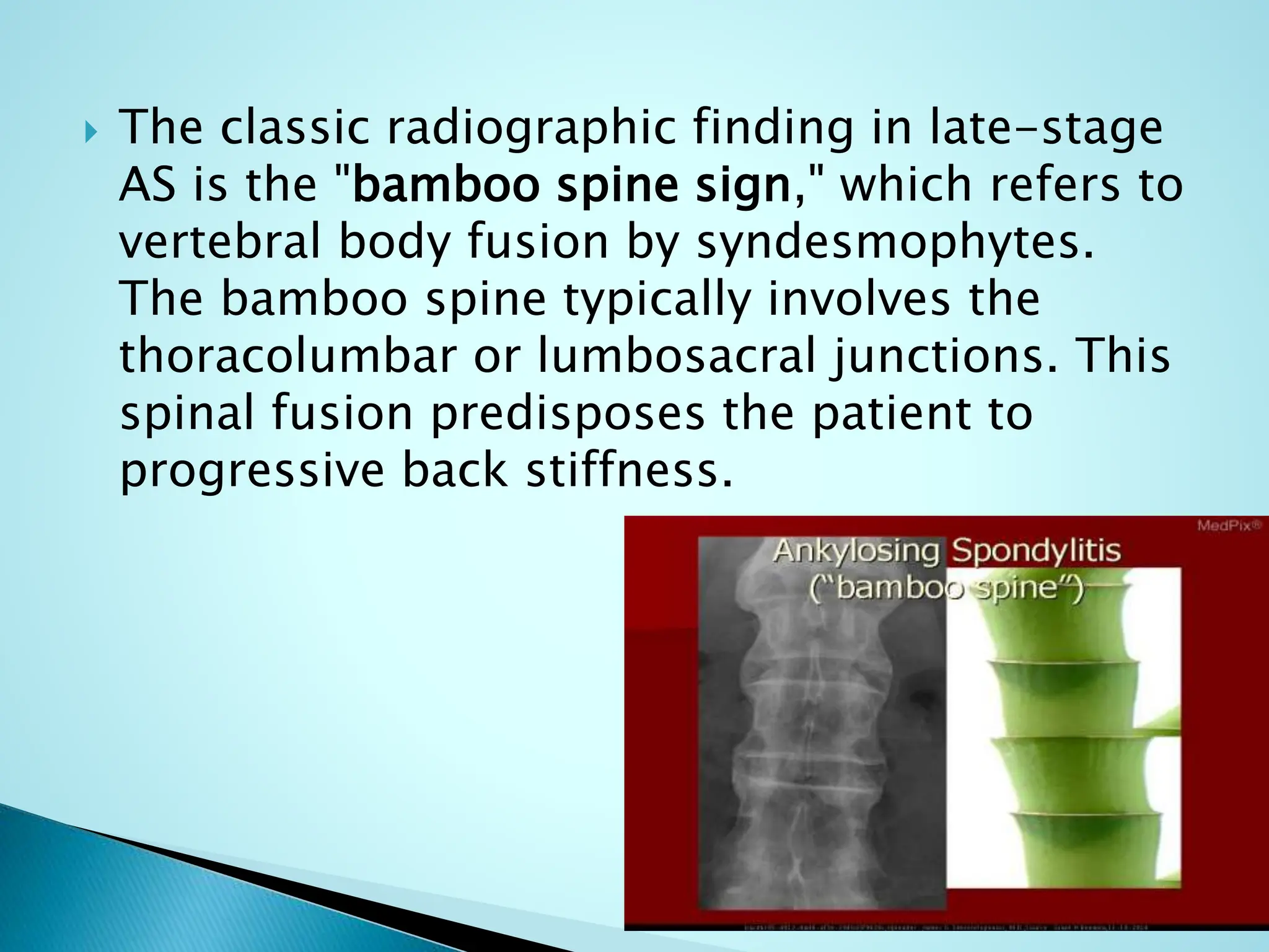 Ankylosing Spondylitis PPT pharmacotherapeutics II | PPTX