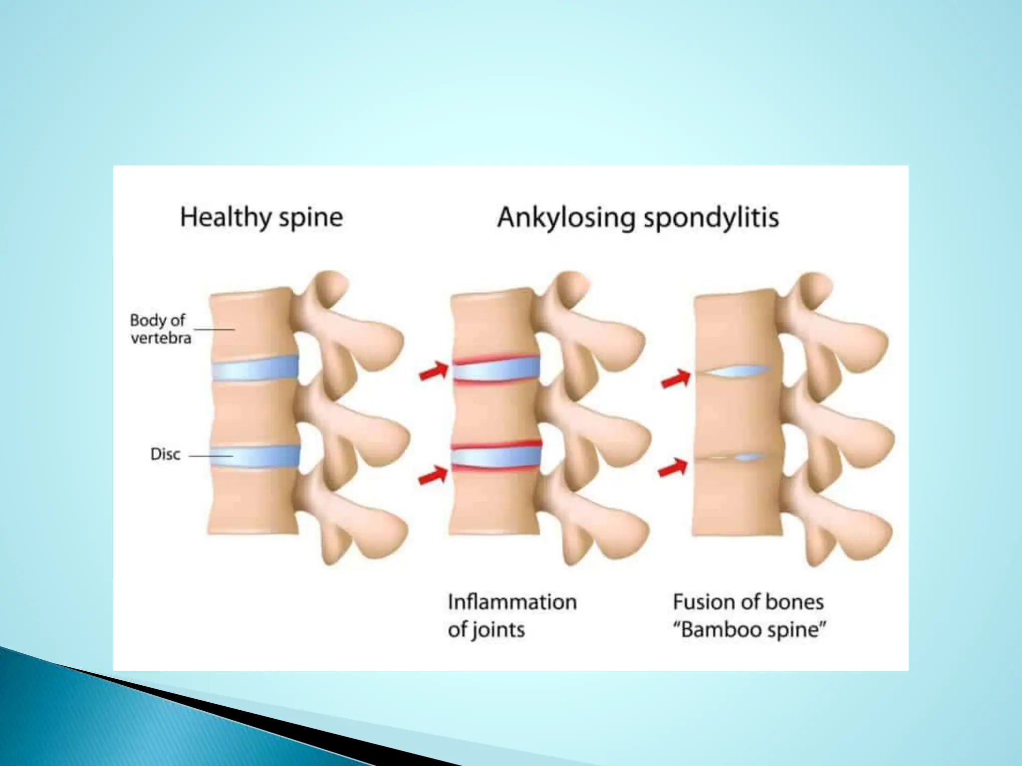 Ankylosing Spondylitis PPT pharmacotherapeutics II | PPTX