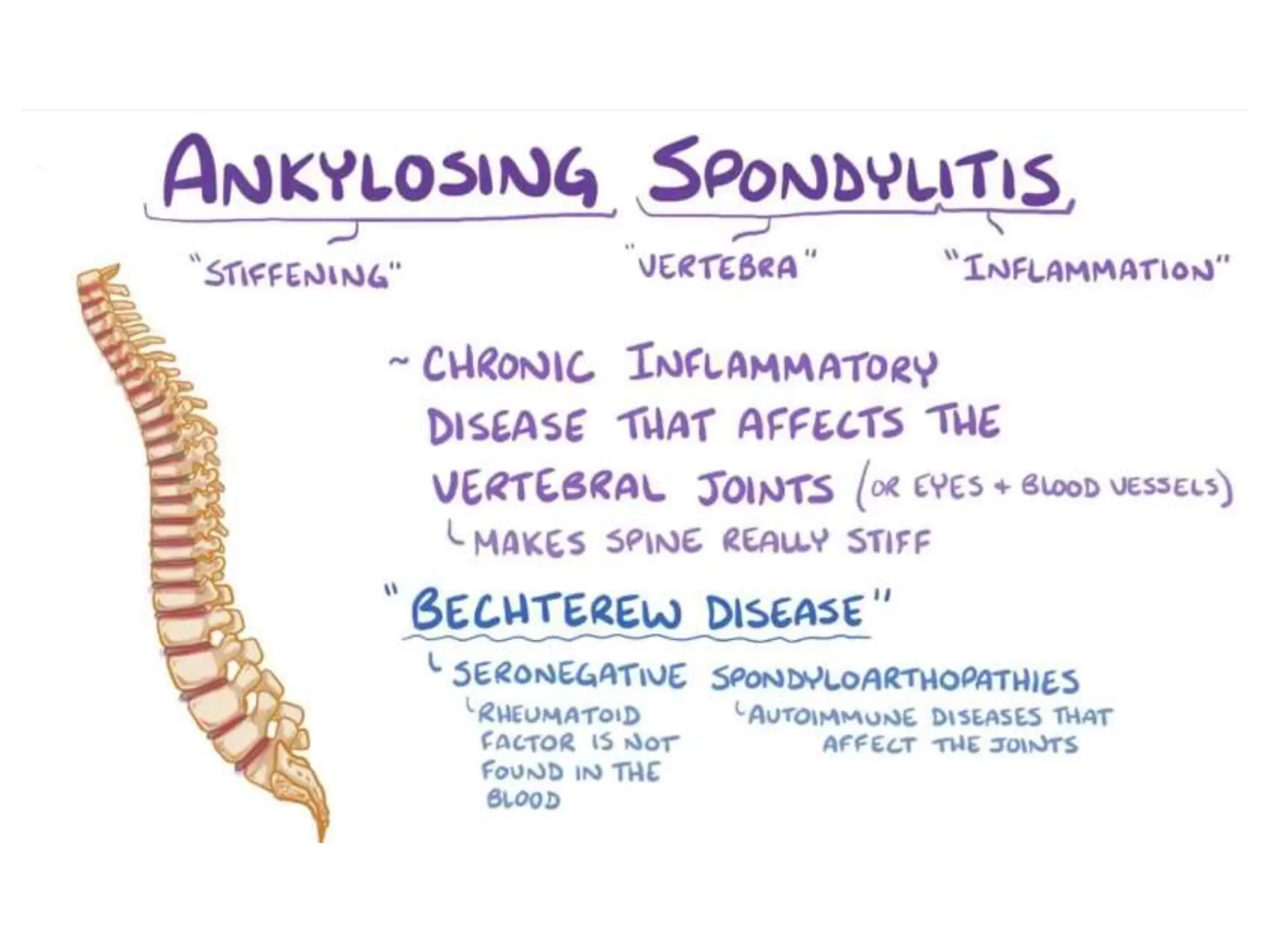 Clinical Pharmacotherapeutic approach of SPONDYLITIS | PPTX