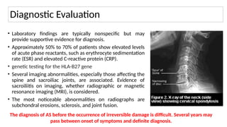Spondylitis: Diagnosis and Treatment as per Guidelines | PPT