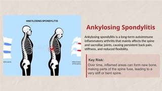 Spondylitis (A Chronic Inflammatory Disease of the Spine).pptx