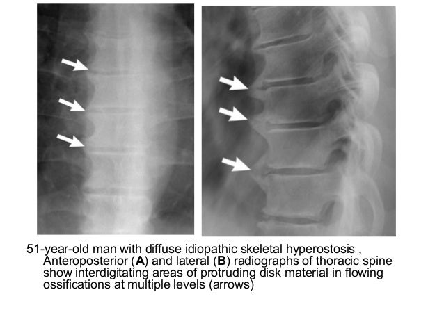 Diagnostic Imaging of Spondyloarthropathies