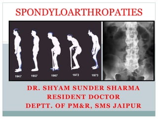Spondyloarthropathies by Dr shyam sunder sharma | PPT
