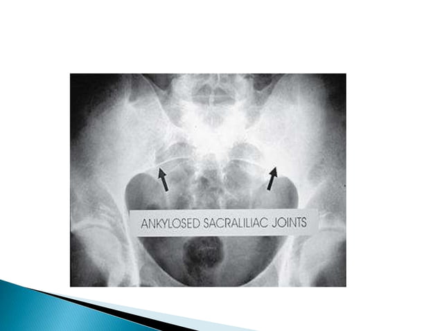 Spondyloarthropathy | PPTX | Bone and Joint Conditions | Diseases and ...