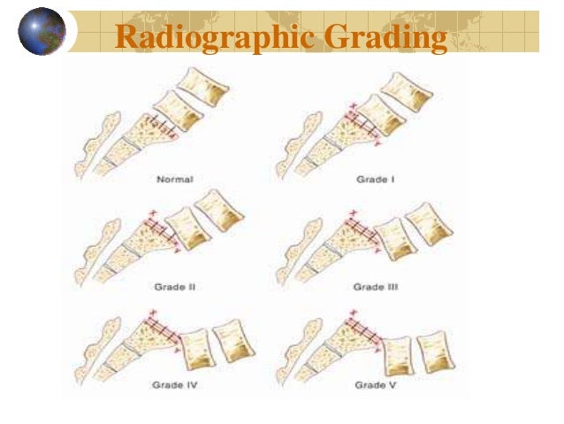 Spondylolisthesis Grades