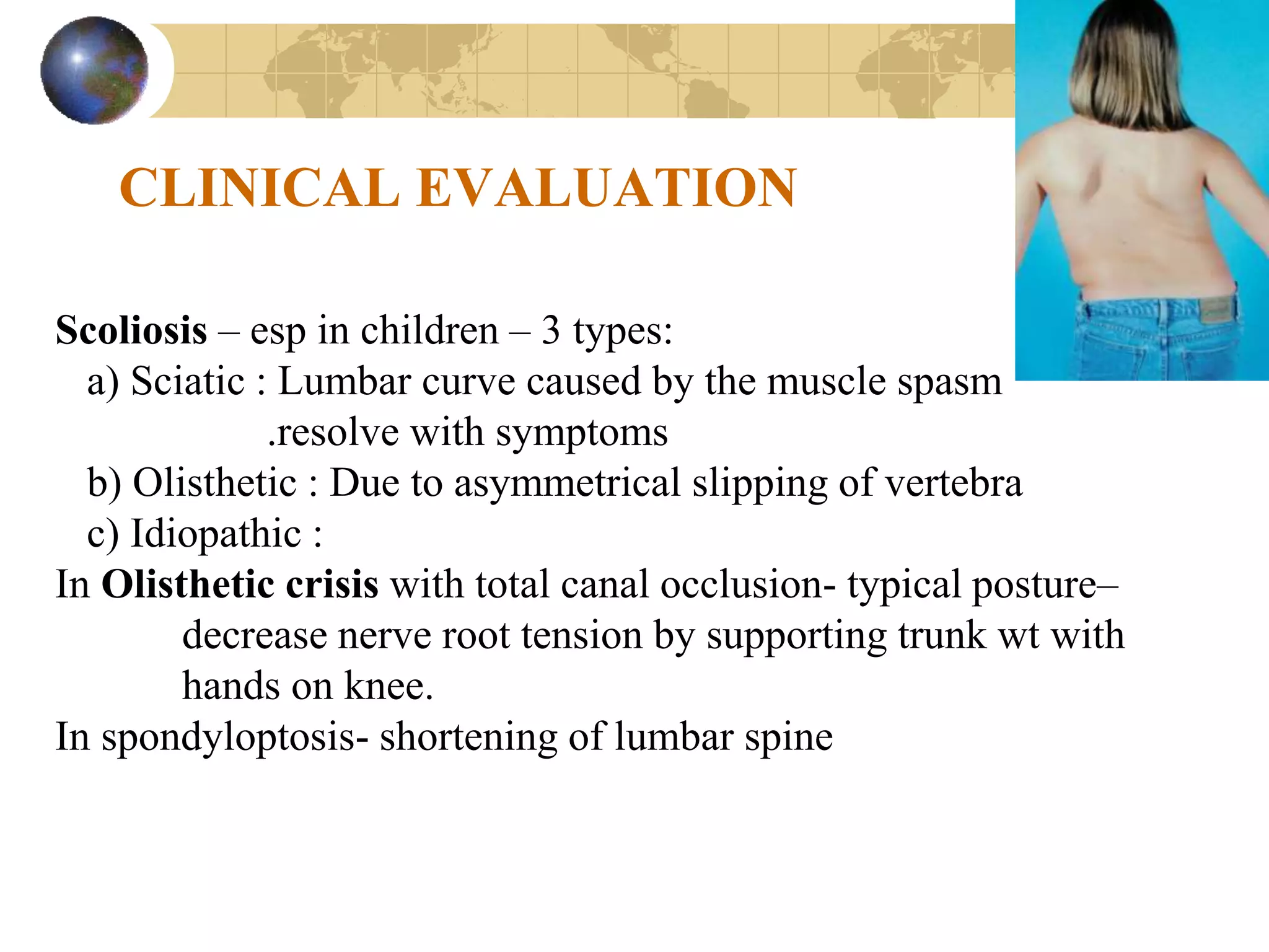 Spondylolisthesis | PPTX