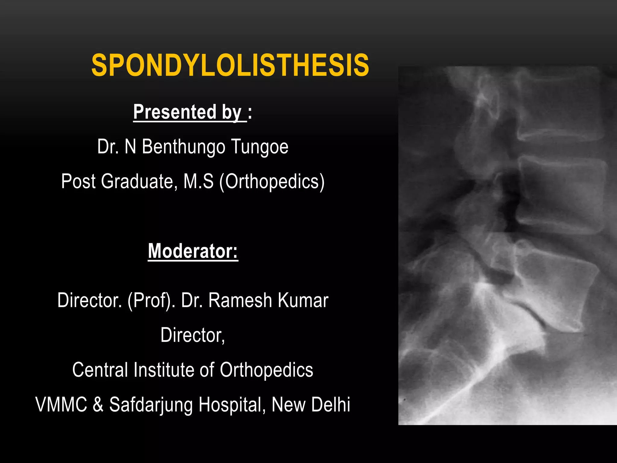 SPONDYLOLISTHESIS: DIAGNOSIS, CLASSIFICATION, EVALUATION AND MANAGEMENT ...