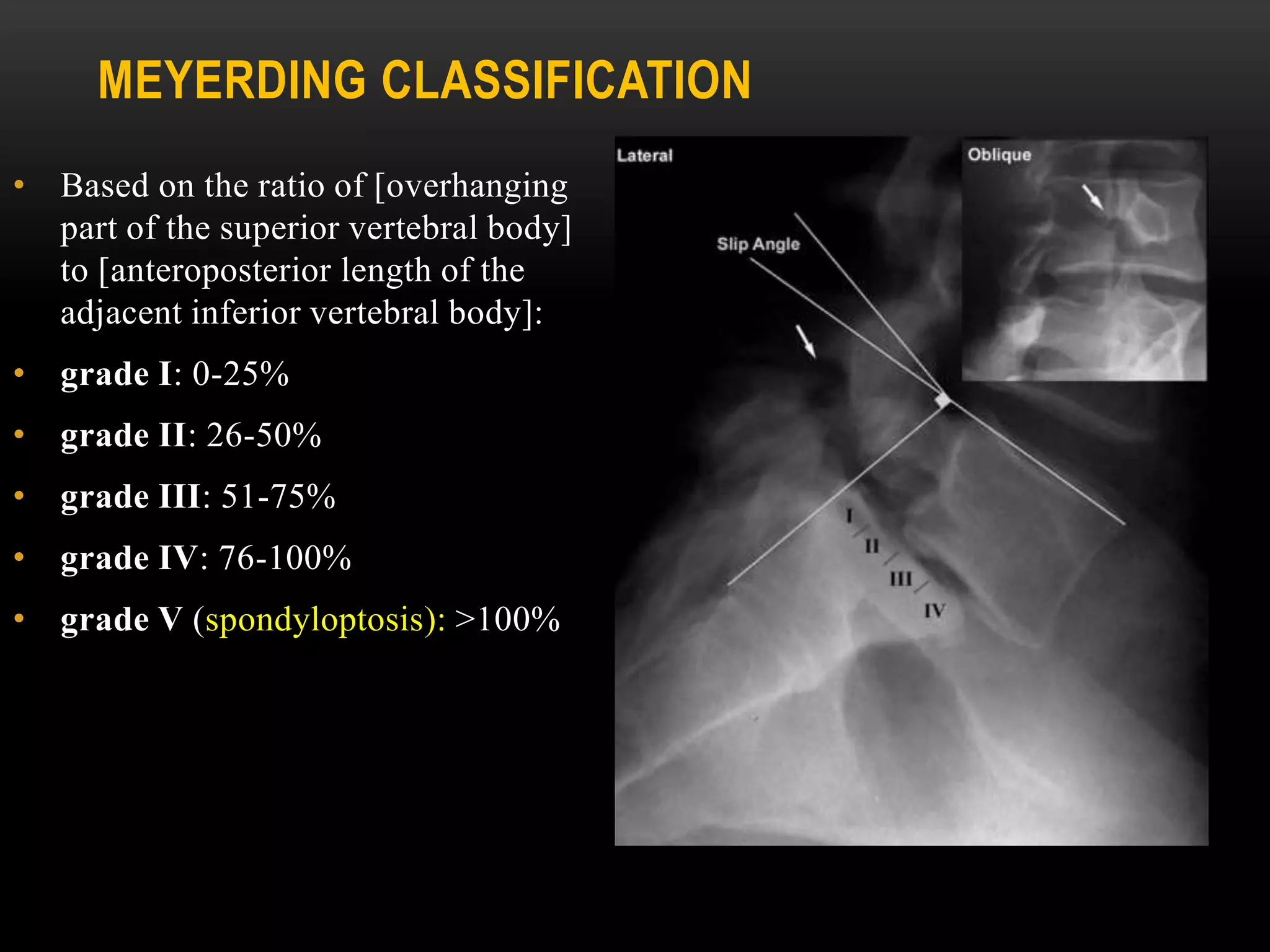 SPONDYLOLISTHESIS: DIAGNOSIS, CLASSIFICATION, EVALUATION AND MANAGEMENT ...