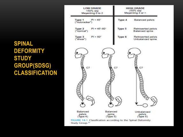 SPONDYLOLISTHESIS: DIAGNOSIS, CLASSIFICATION, EVALUATION AND MANAGEMENT ...