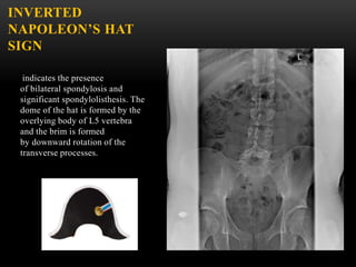 SPONDYLOLISTHESIS: DIAGNOSIS, CLASSIFICATION, EVALUATION AND MANAGEMENT ...