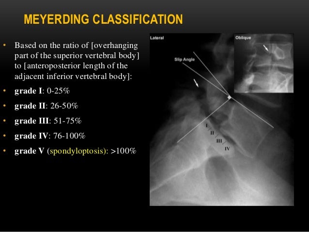SPONDYLOLISTHESIS: DIAGNOSIS, CLASSIFICATION, EVALUATION AND MANAGEME…