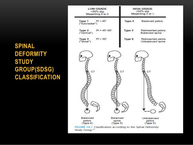 SPONDYLOLISTHESIS: DIAGNOSIS, CLASSIFICATION, EVALUATION AND MANAGEME…