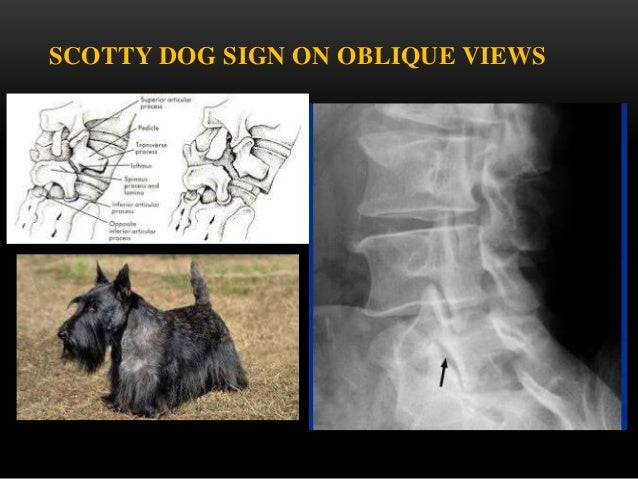 SPONDYLOLISTHESIS: DIAGNOSIS, CLASSIFICATION, EVALUATION AND MANAGEME…