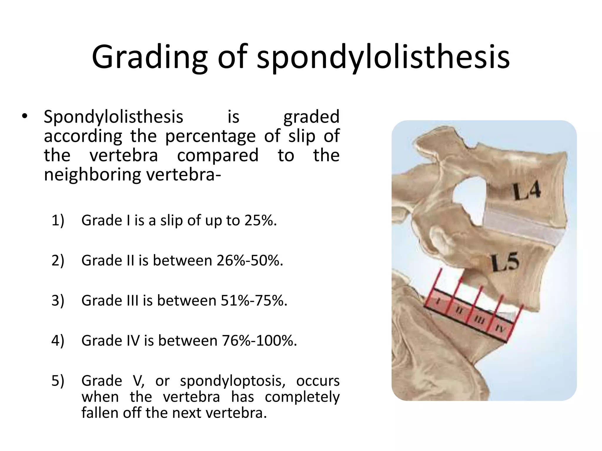 Spondylolisthesis | PPTX