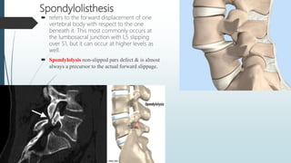 Spondylolisthesis | PPT