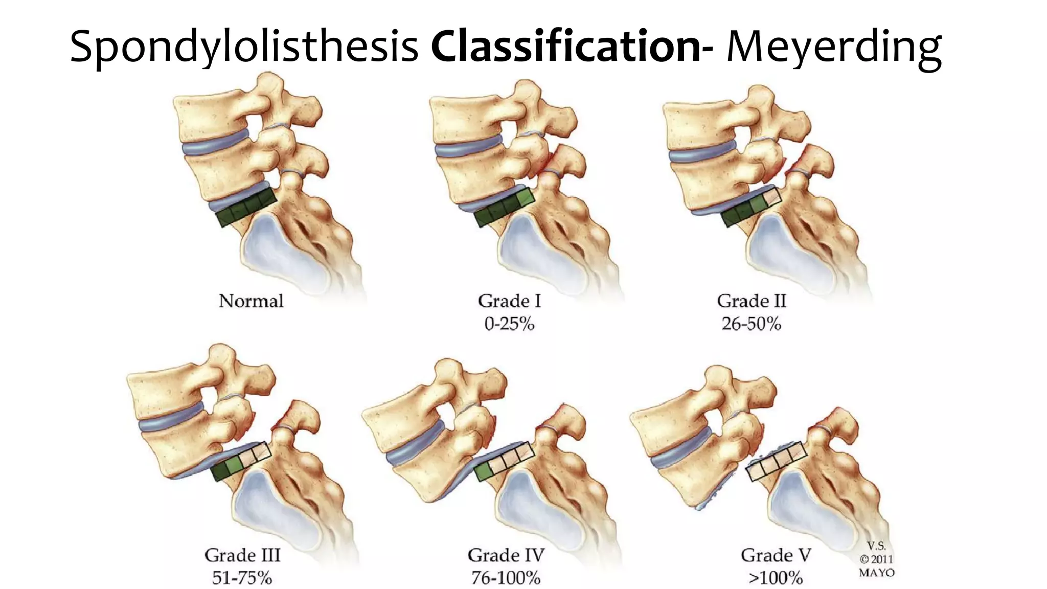 Spondylolisthesis | PPTX