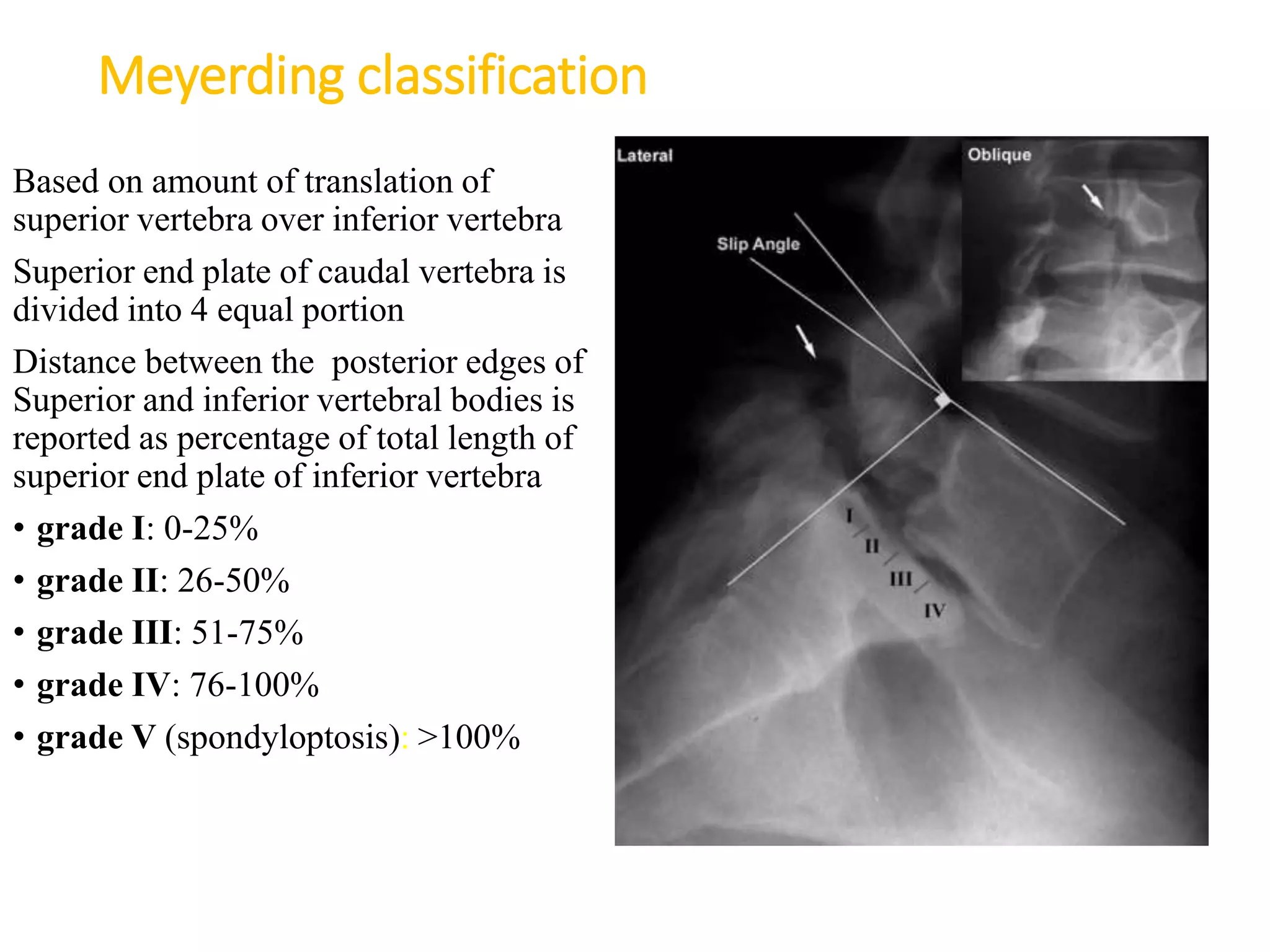 Spondylolisthesis | PPTX