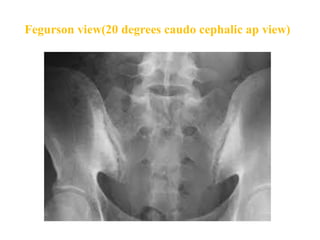 Ferguson View Of Lumbar Spine