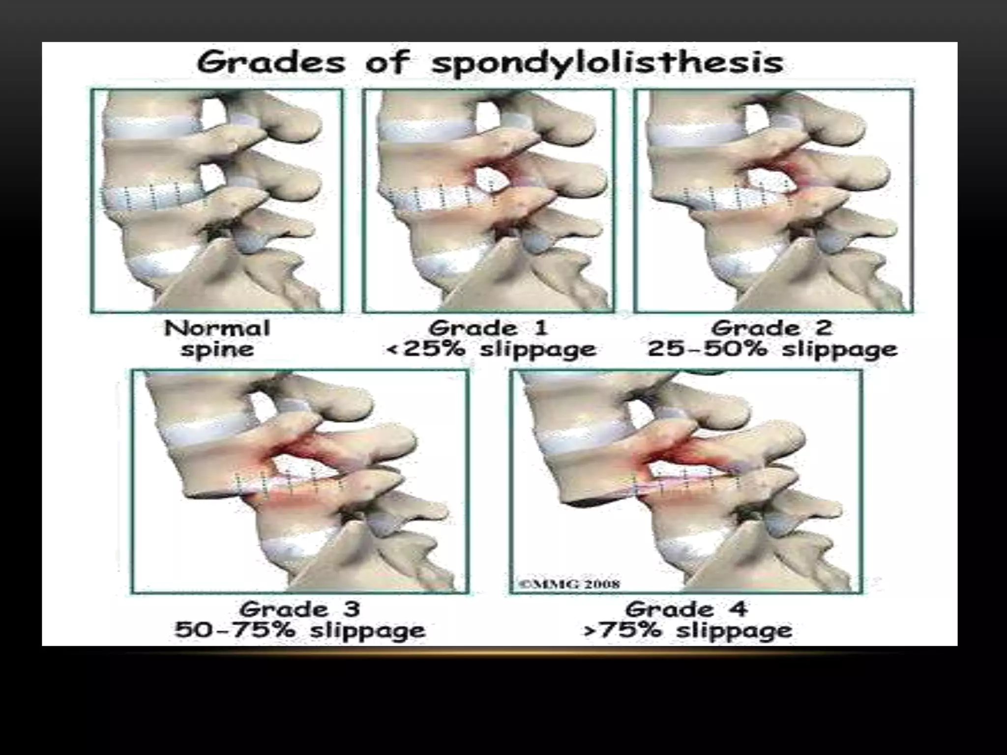Spondylolisthesis | PPT