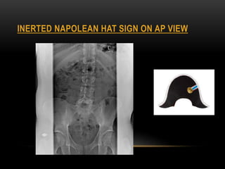 Spondylolisthesis | PPT