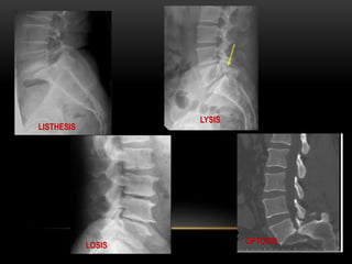 Spondylolisthesis | PPT