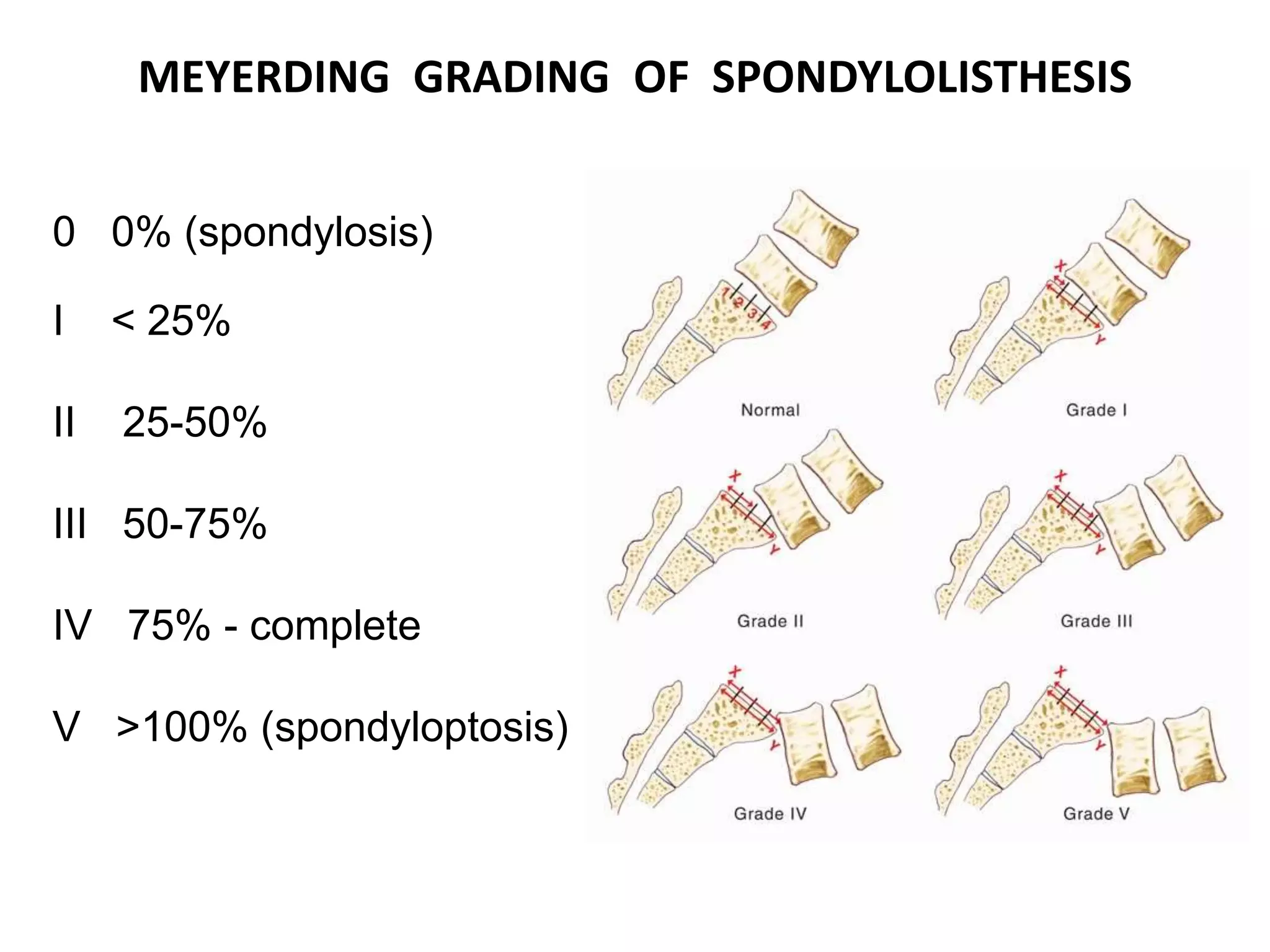 Spondylolisthesis | PPTX