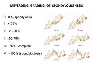 Spondylolisthesis | PPTX