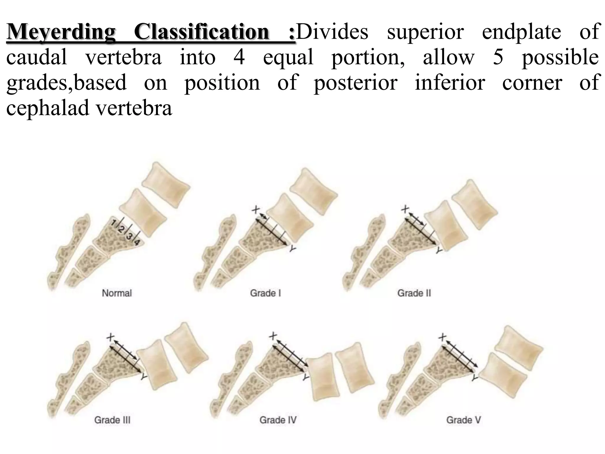 SPONDYLOLISTHESIS.ppt