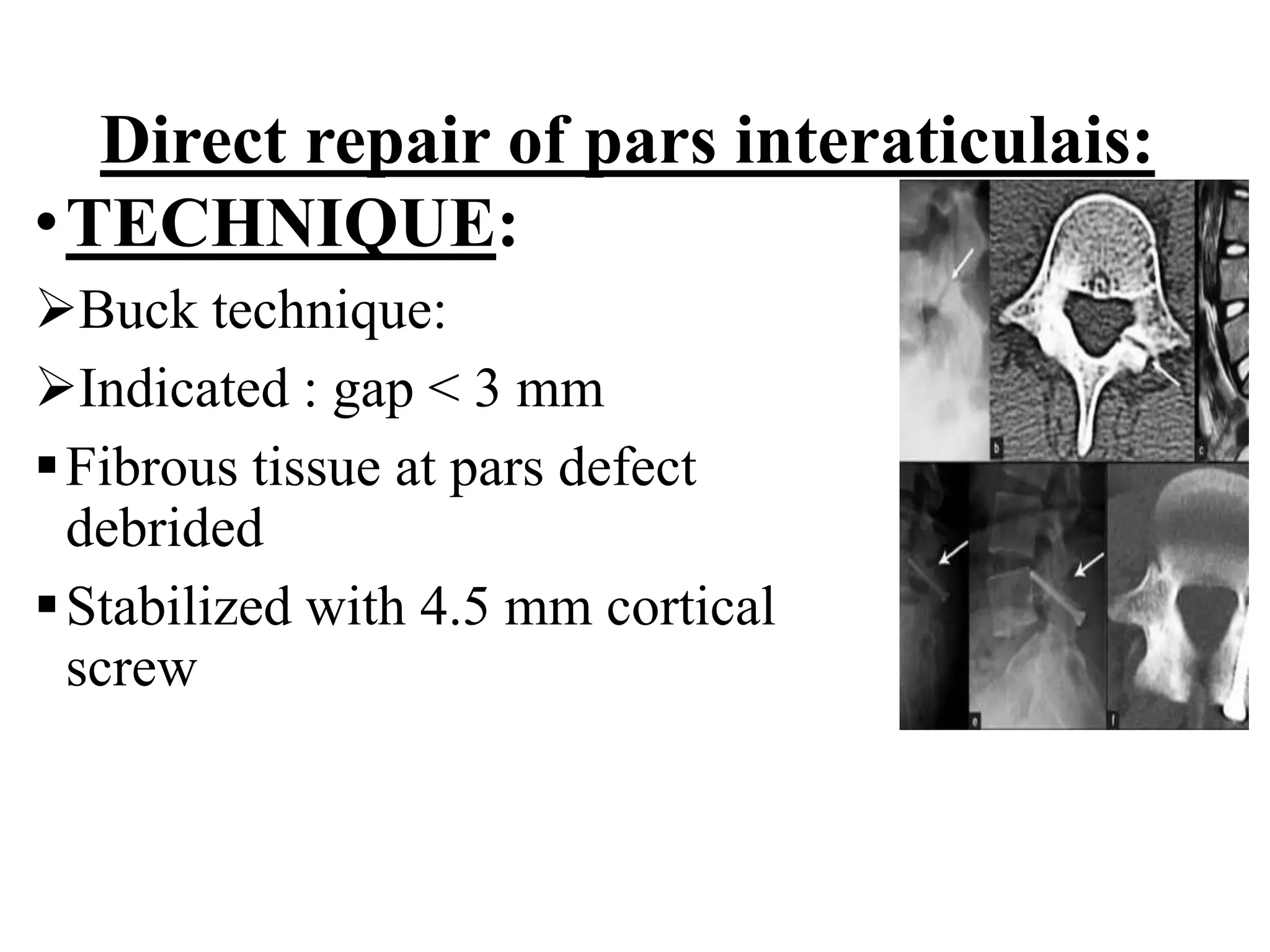 SPONDYLOLISTHESIS.ppt