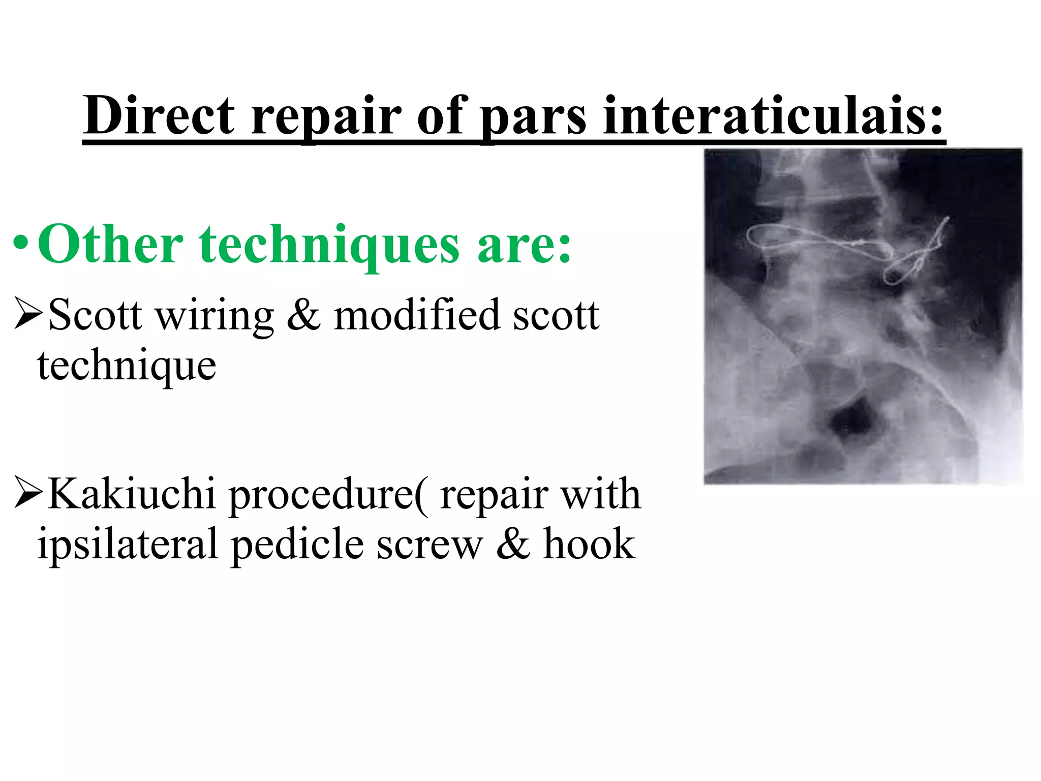 SPONDYLOLISTHESIS.ppt