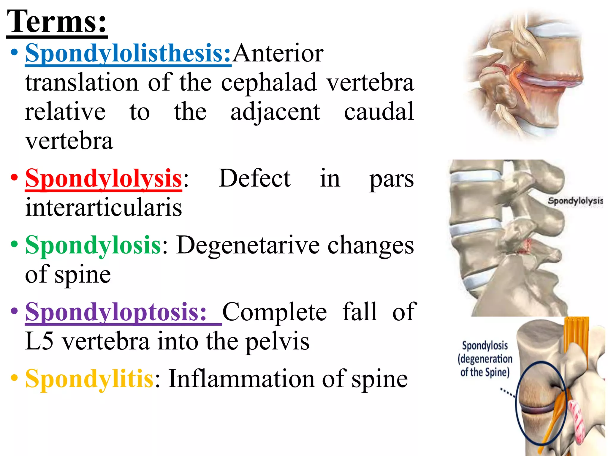 SPONDYLOLISTHESIS.ppt