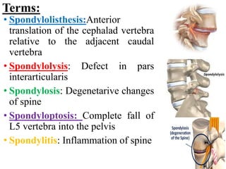 SPONDYLOLISTHESIS.ppt