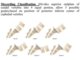 SPONDYLOLISTHESIS.ppt