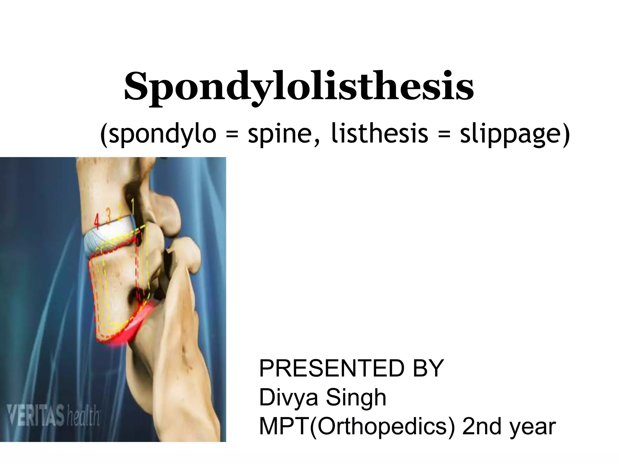 Spondylolisthesis.pptx