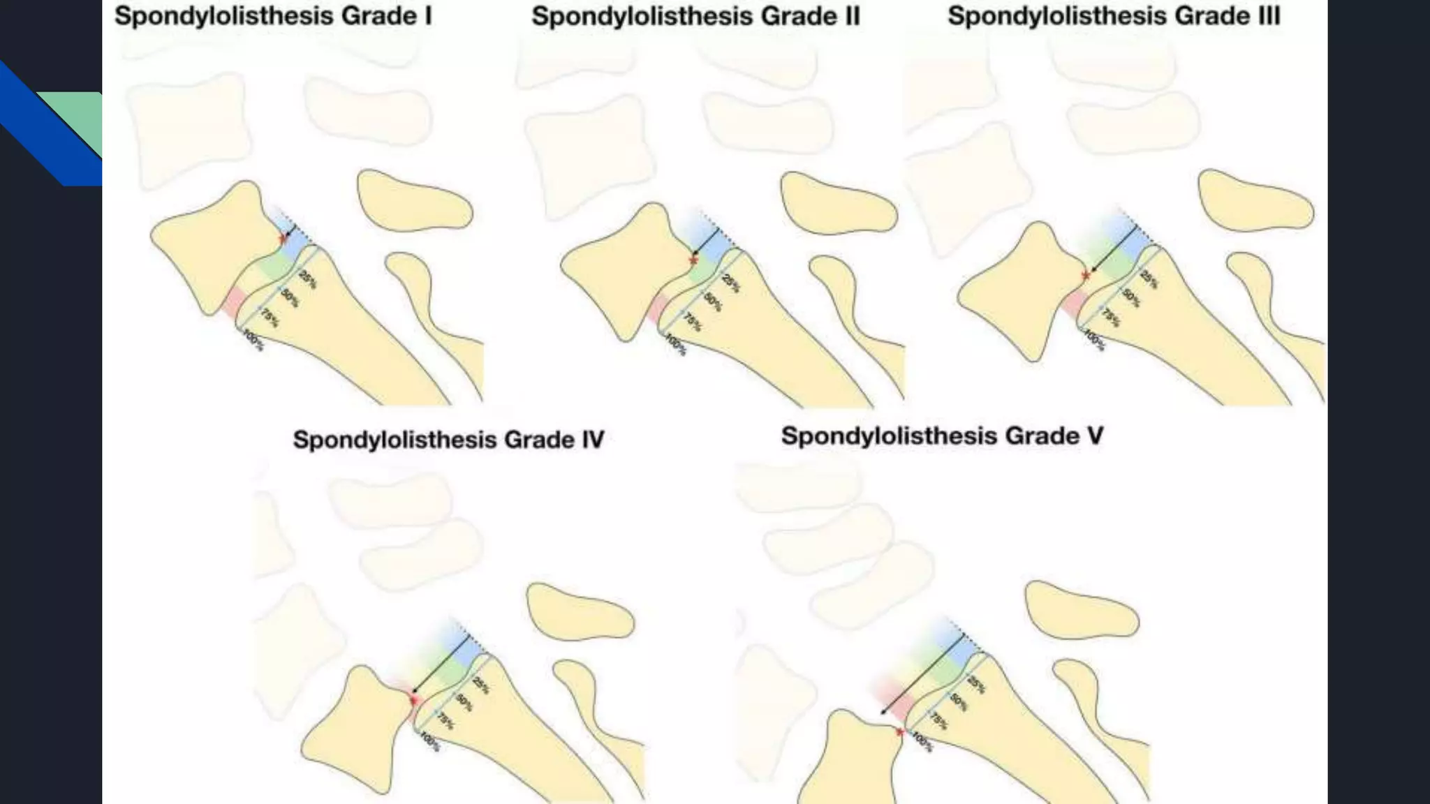 spondylolisthesis.pptx