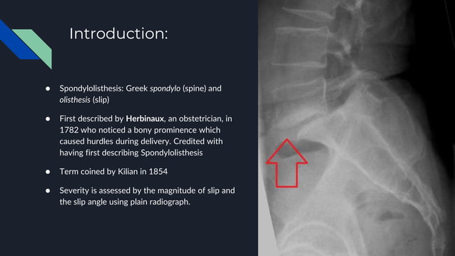 spondylolisthesis.pptx