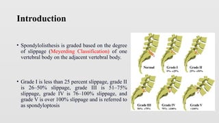 Spondylolisthesis.pptx Spondylolisthesis is a spinal condition in which ...