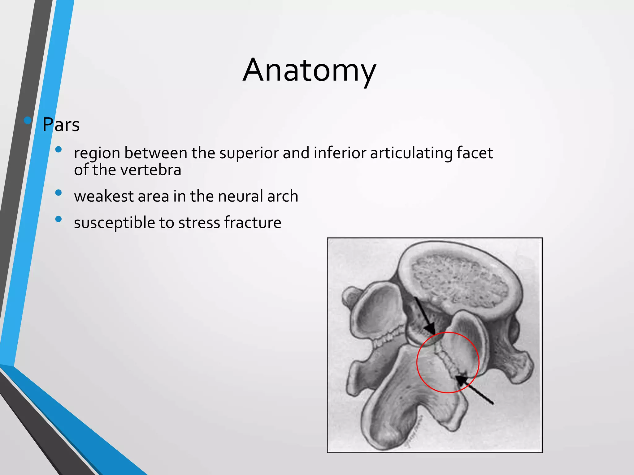 Spondylolisthesis | PPTX