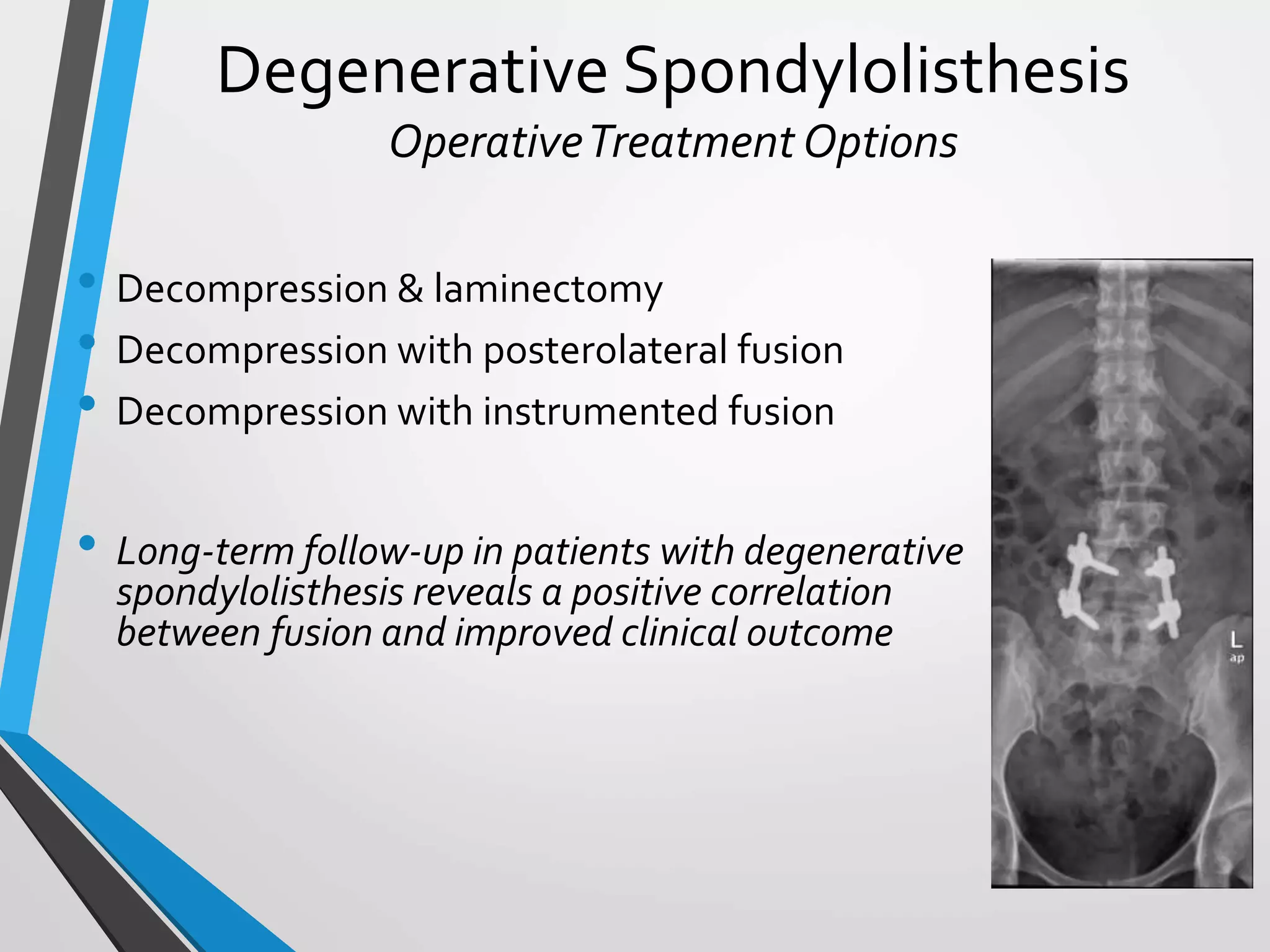 Spondylolisthesis | PPTX