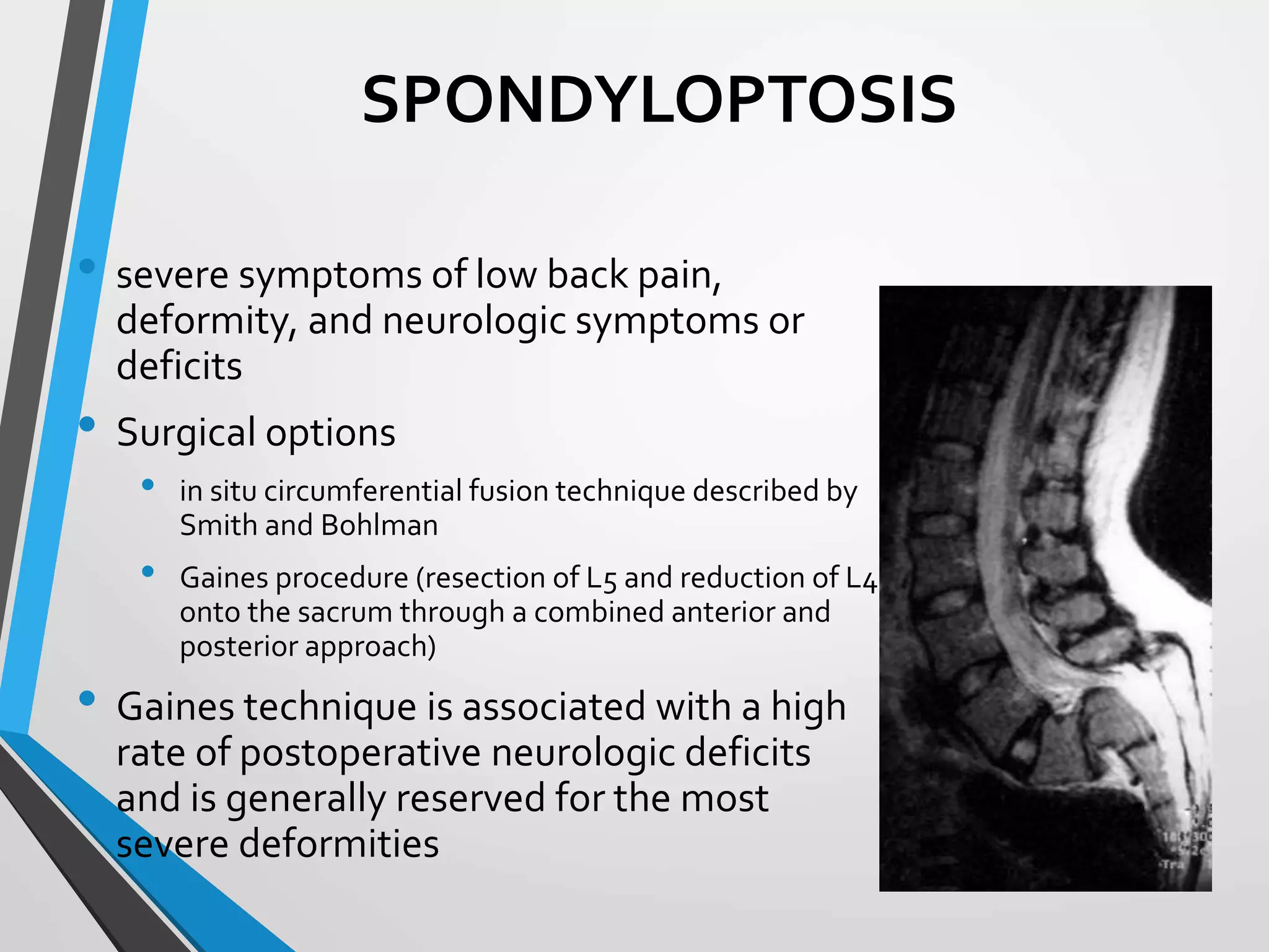 Spondylolisthesis | PPTX