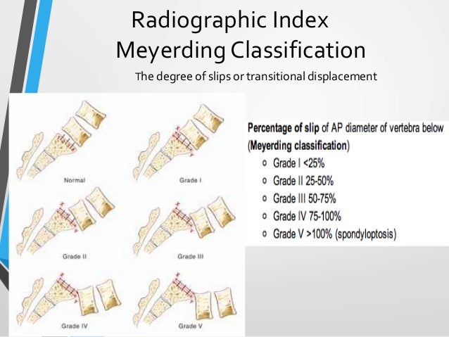 Spondylolisthesis