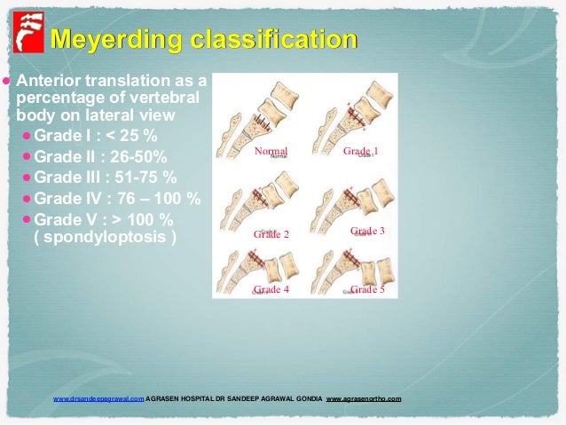 Spondylolisthesis as an entity for back pain agrasen hospital gondia
