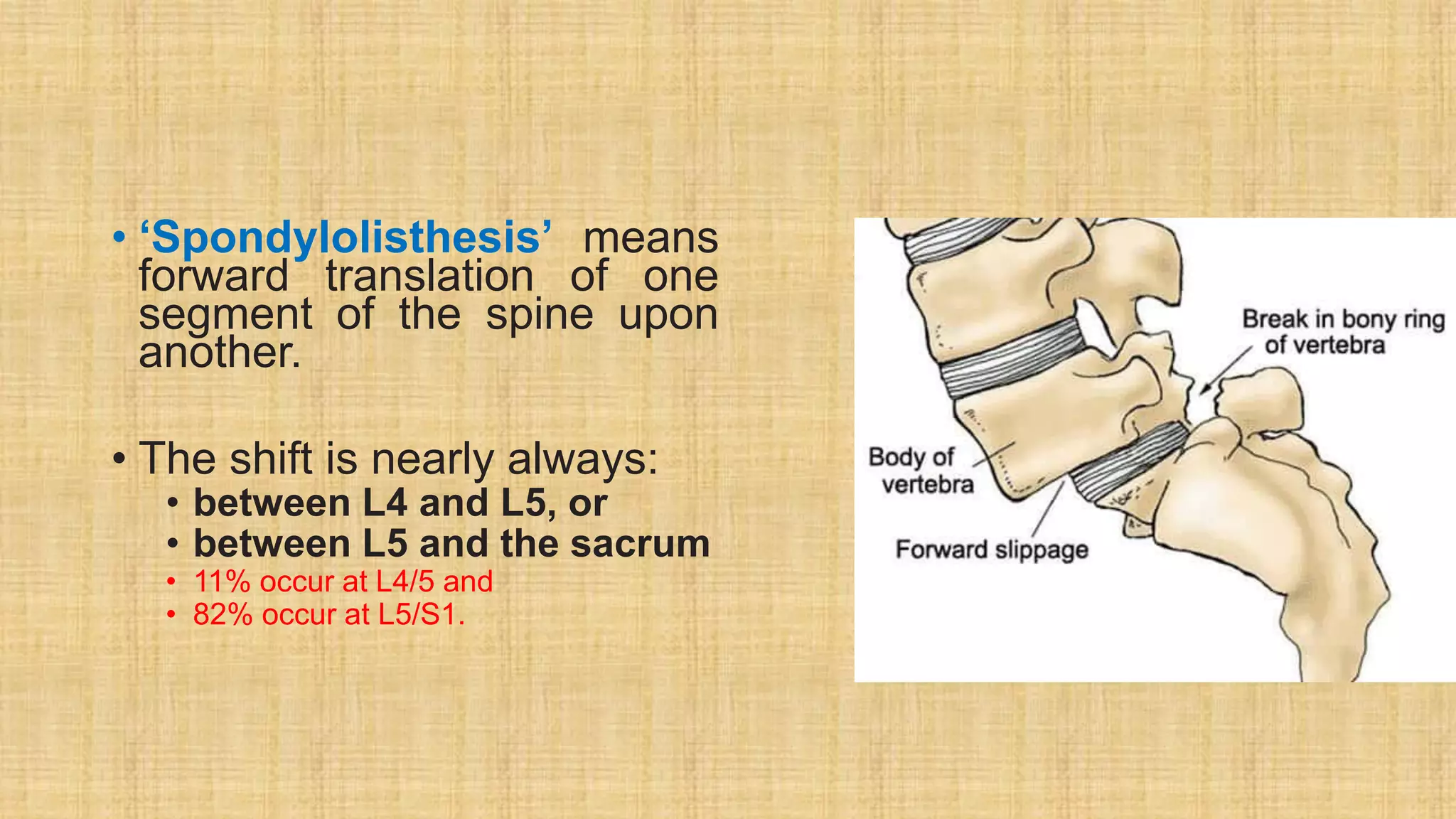 Spondylolisthesis | PDF