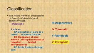 Spondylolisthesis | PDF