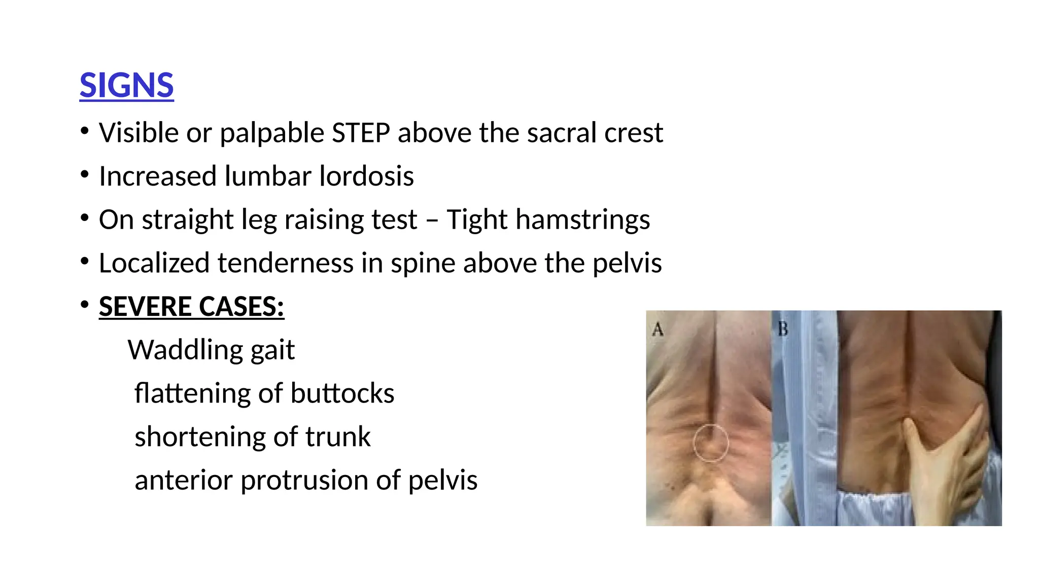 SPONDYLOLISTHESIS DRD.pptx