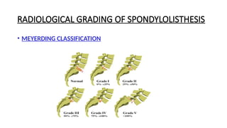 SPONDYLOLISTHESIS DRD.pptx