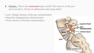 Spondylolisthesis, Lumbar Spondylosis.pptx