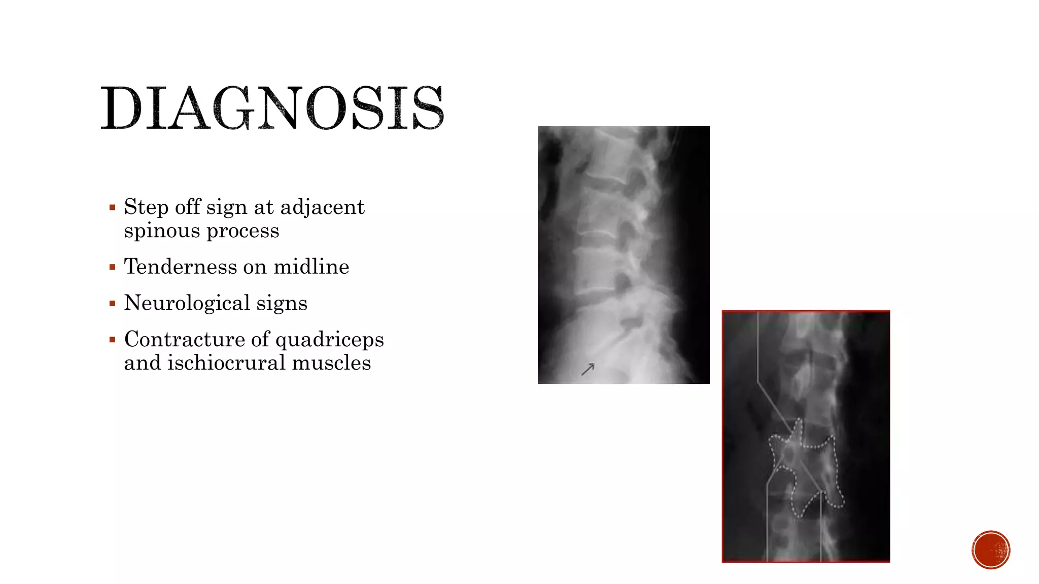Spondylolisthesis in adults and children | PPTX