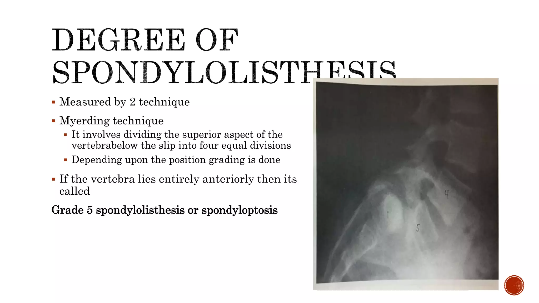 Spondylolisthesis in adults and children | PPTX