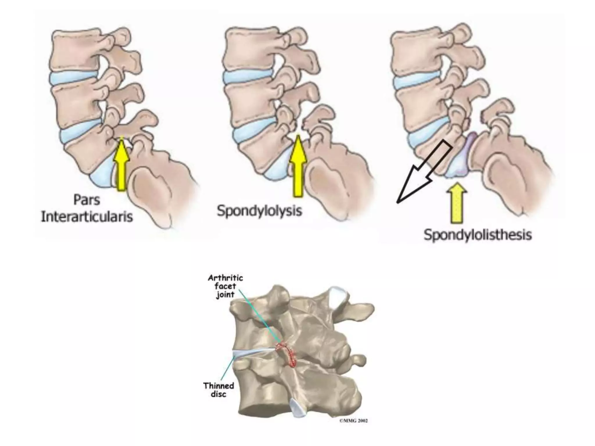 Spondylolisthesis neel.pptx